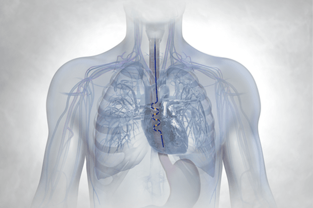 CIRCA S-Cath Features: Esophageal Landmarks | CIRCA
